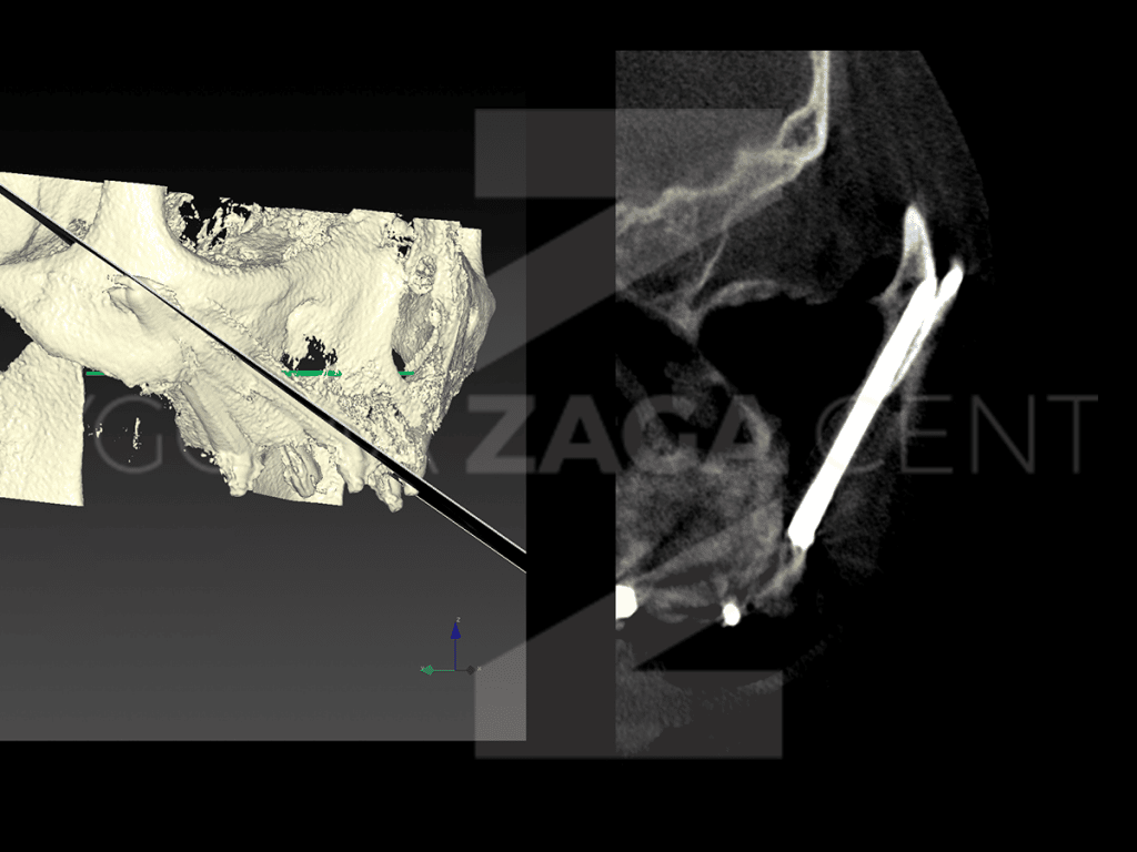 Treatment of the severely atrophic maxilla