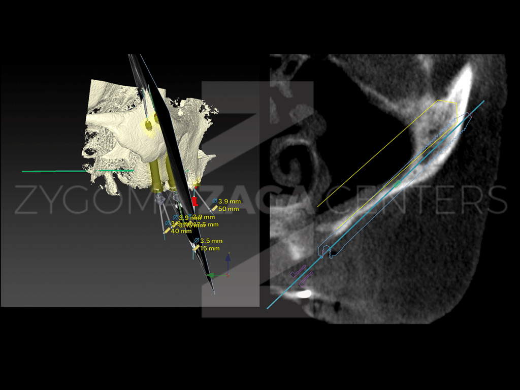 Treatment of the severely atrophic maxilla