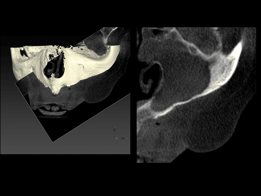 Treatment of the severely atrophic maxilla