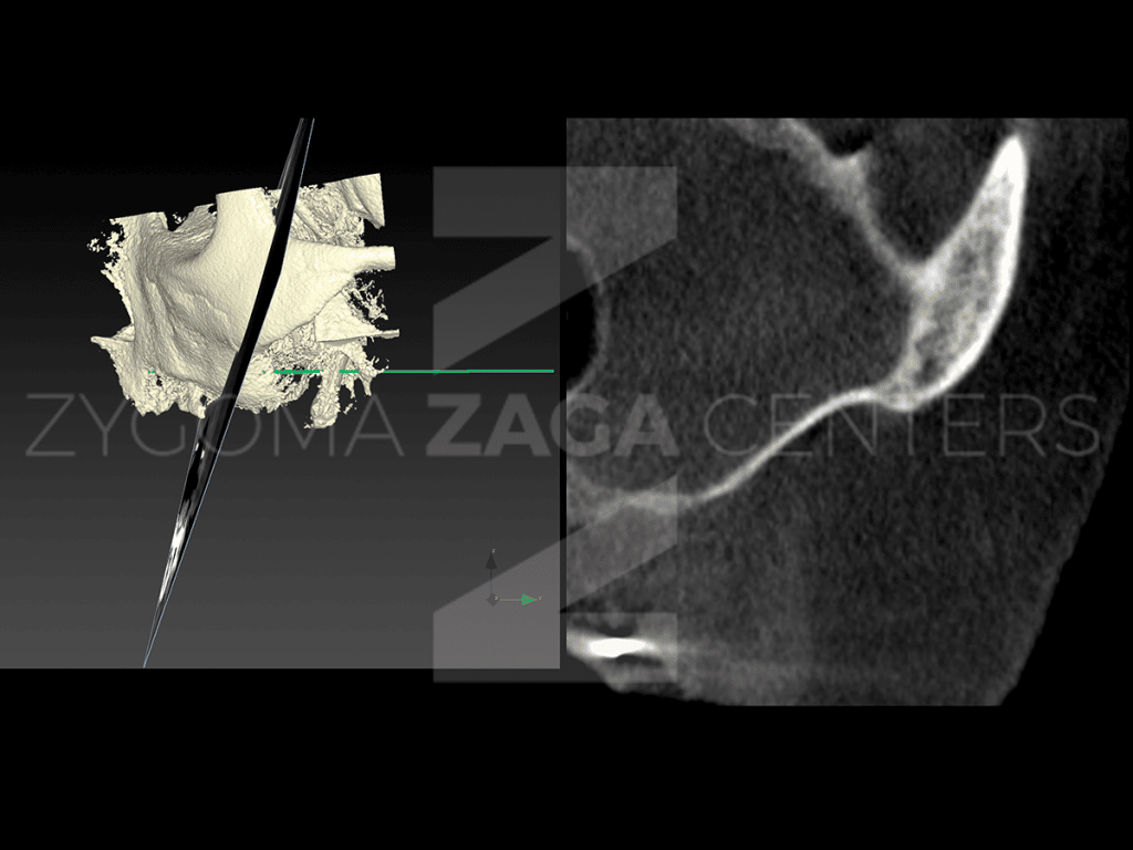 Treatment of the severely atrophic maxilla