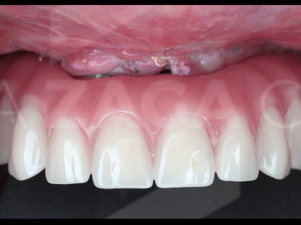 Management of a surgical complication in an atrophied maxilla