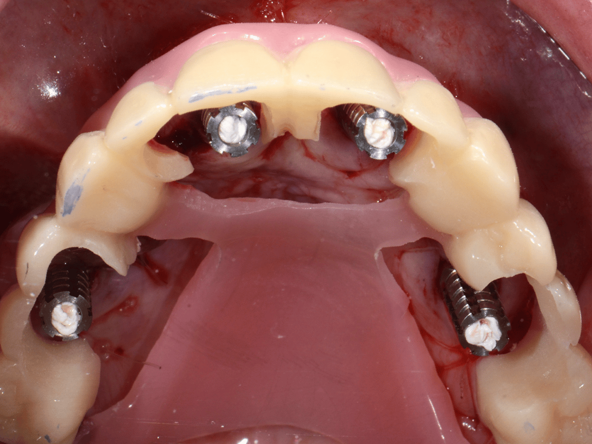 ZAGA Centers - Management of a severely atrophic maxilla with zygoma ...