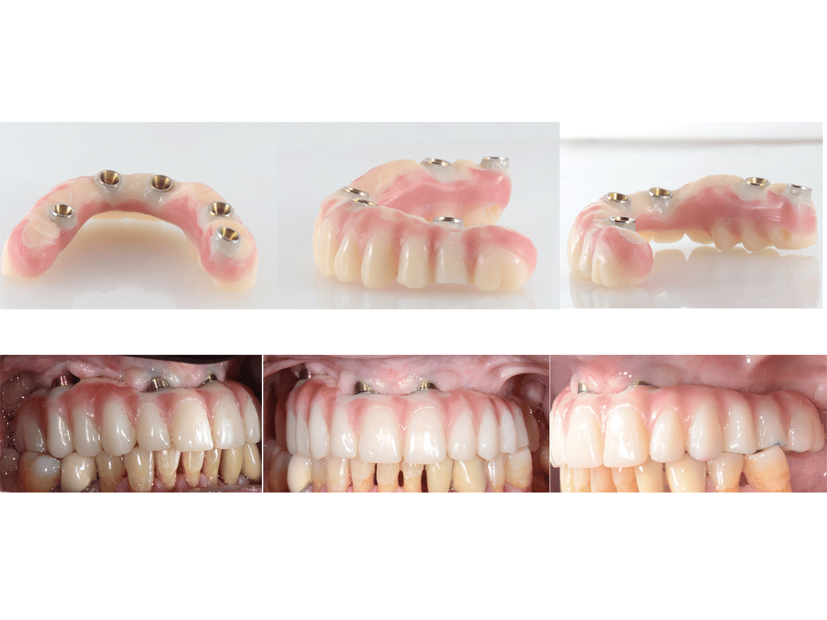 ZAGA Centers - Management of a severely atrophic maxilla with zygoma ...