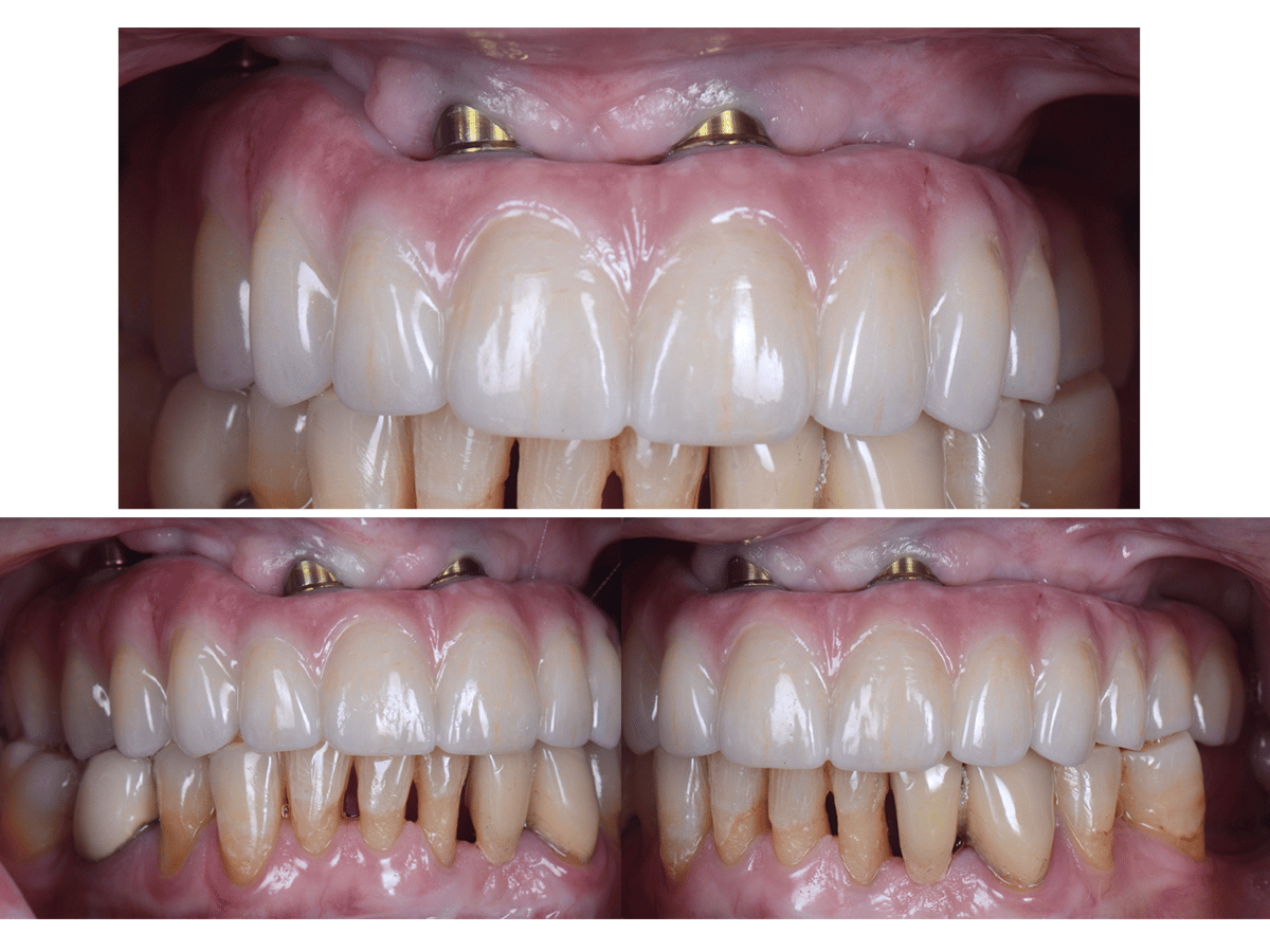 ZAGA Centers - Management of a severely atrophic maxilla with zygoma ...