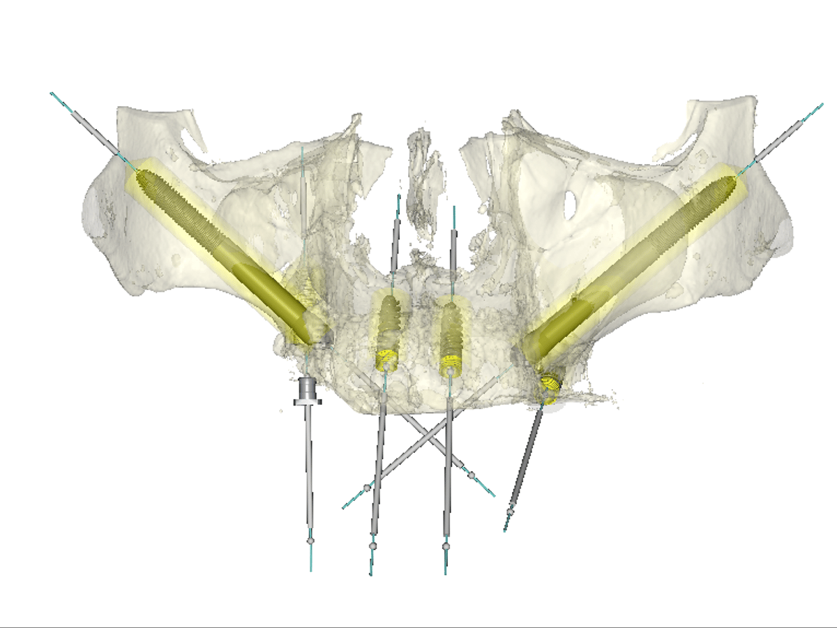 ZAGA Centers - Management of a severely atrophic maxilla with zygoma ...