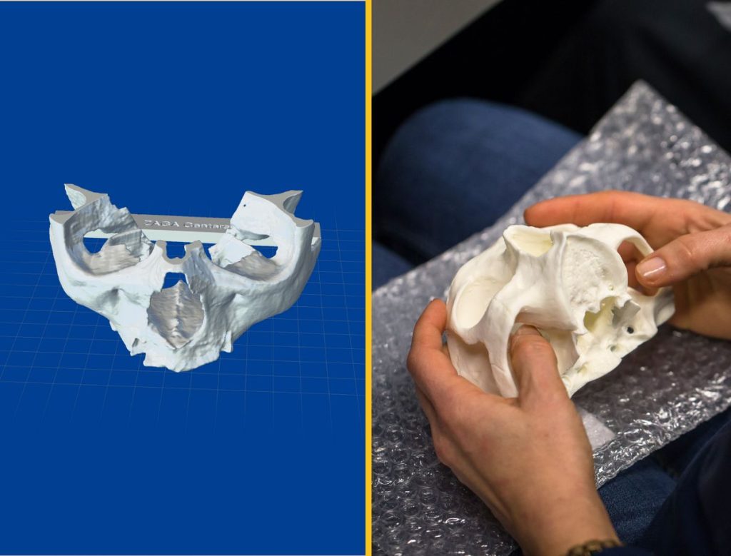 Dental 3D Model for surgery rehearsal and patient education